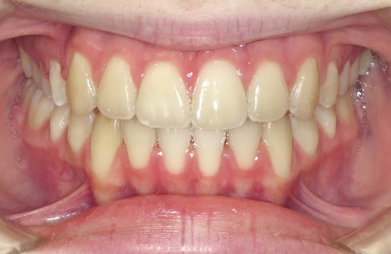 xbite-after-1 – Norton Dental Vaughan